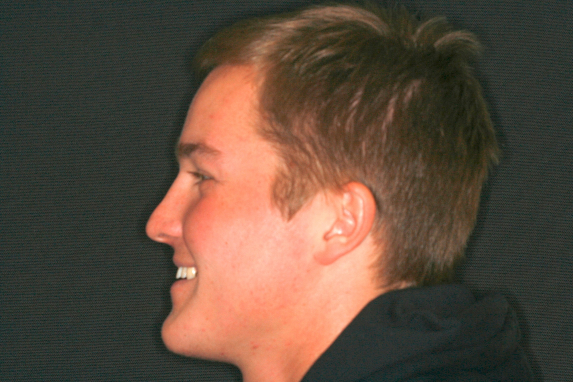 Can I Fix My Underbite Without Surgery Ronald Konig DDS