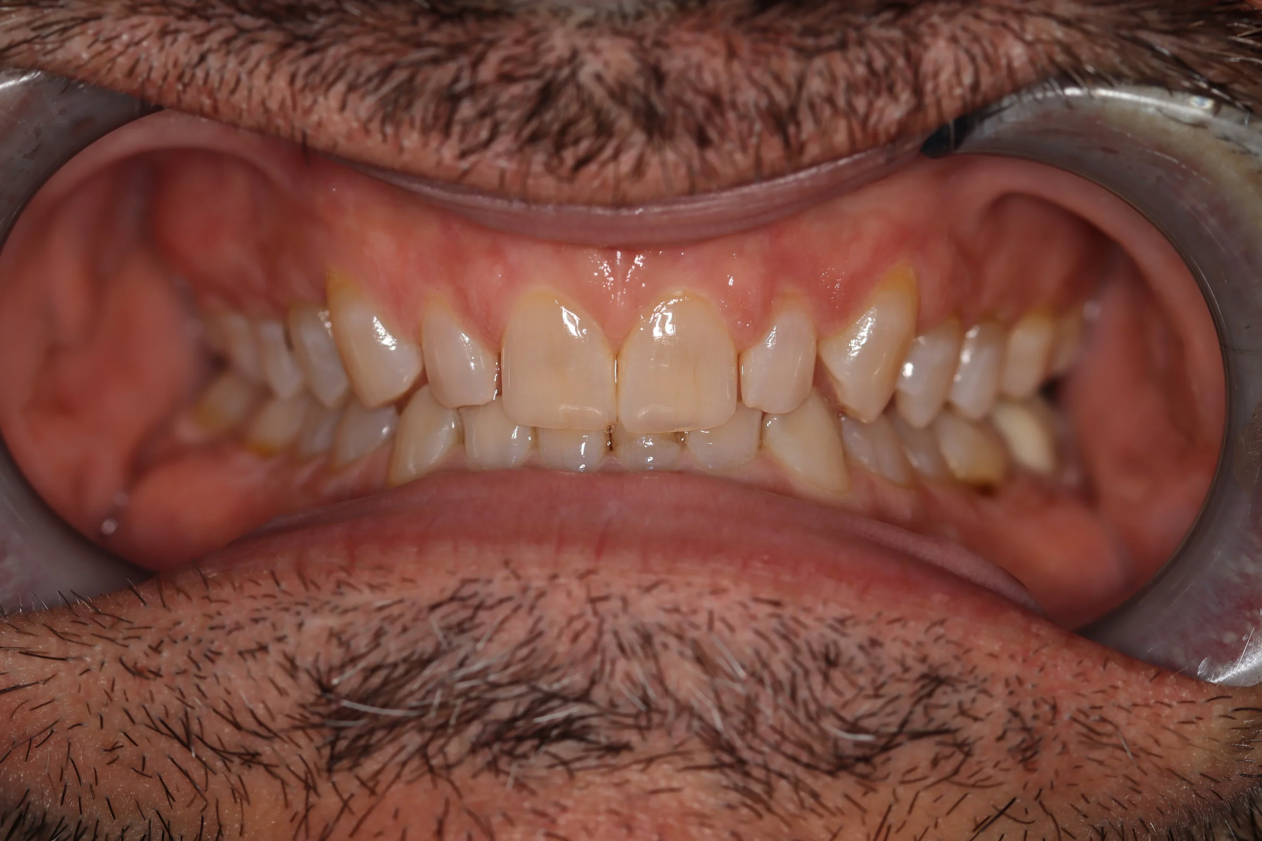 Nonsurgical Bite Correction in Houston, TX